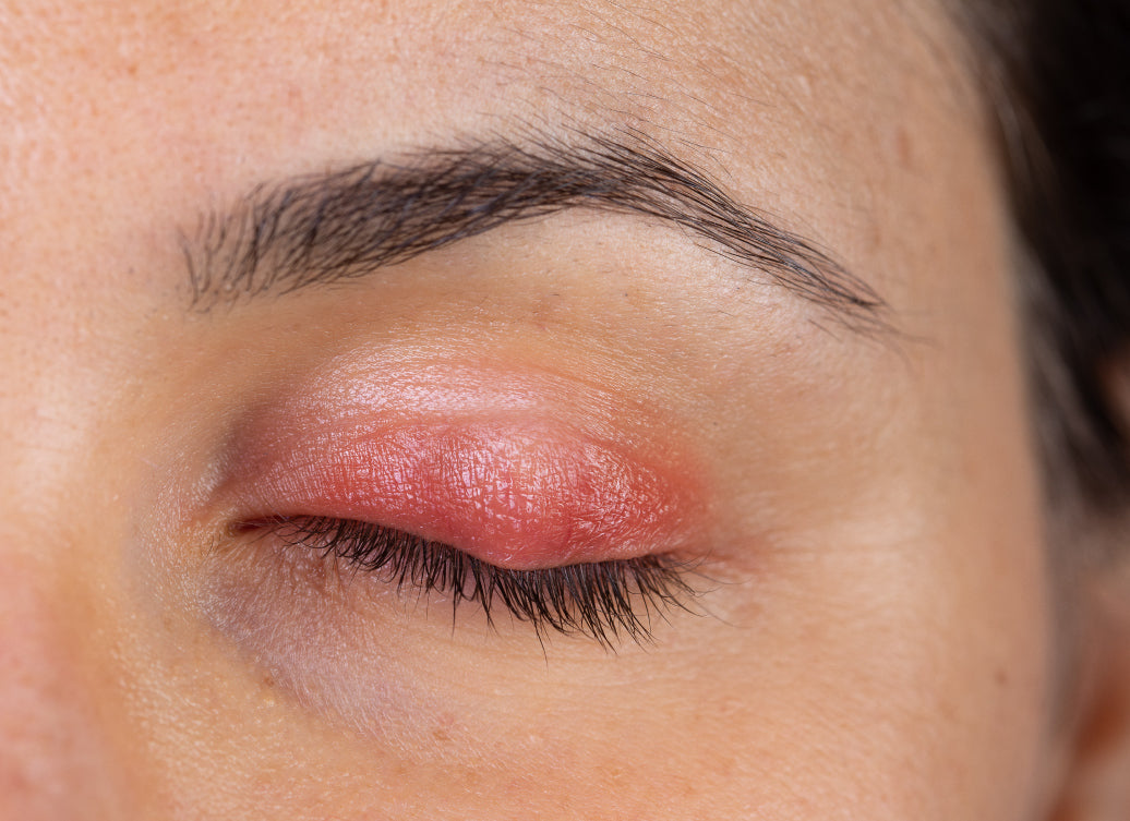How Long Does Blepharitis Take To Go Away? – Balmonds